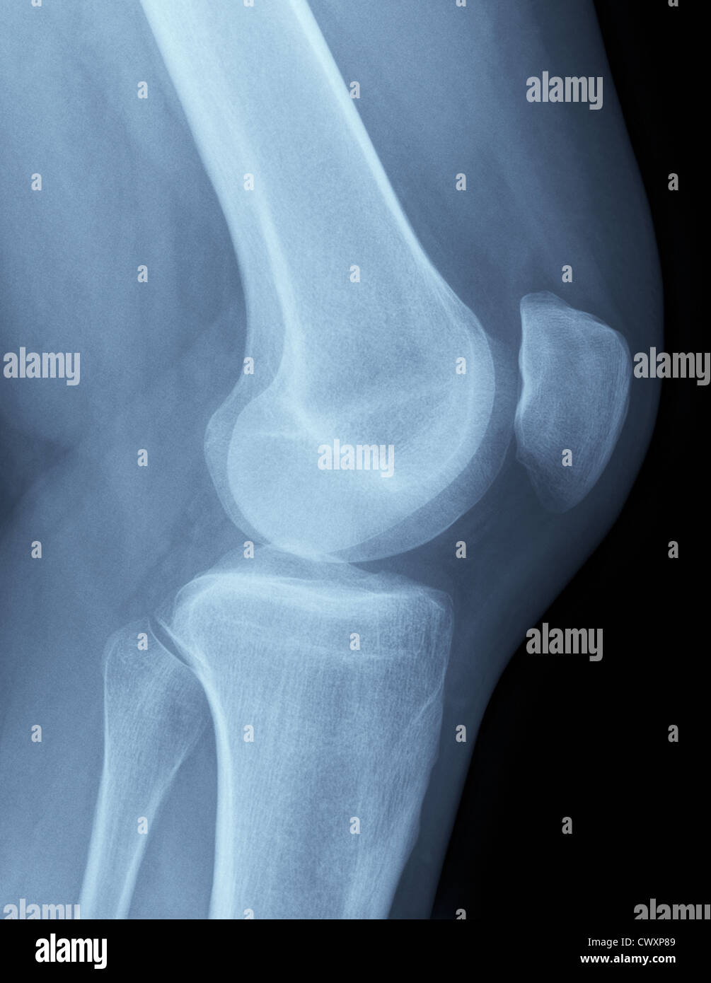 X ray of articular cartilage hi-res stock photography and images - Alamy