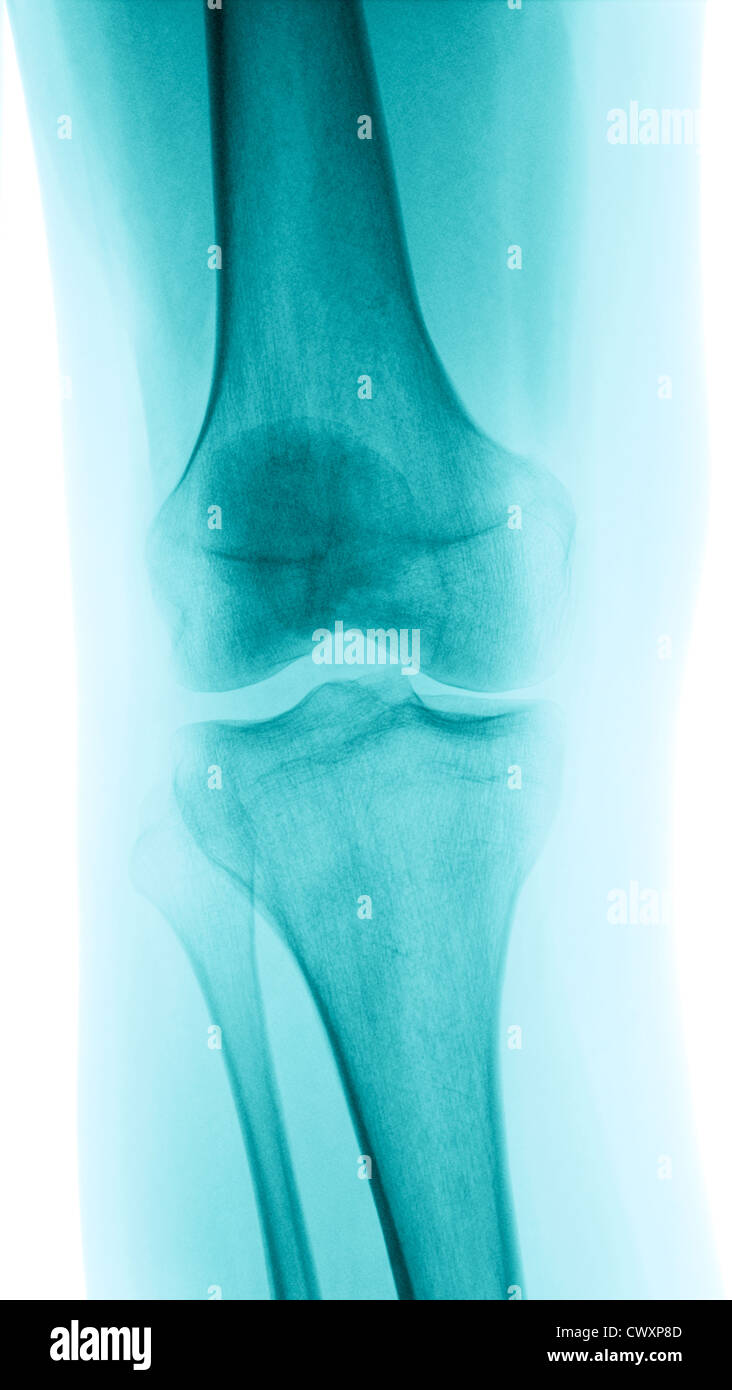 Detailed X-ray of a healthy human right knee. Image created using ...