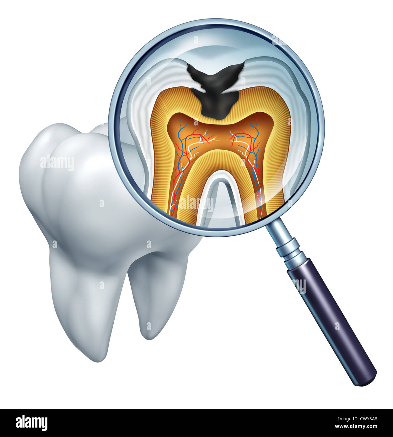 Tooth cavity close up and cavities symbol showing a magnifying glass ...