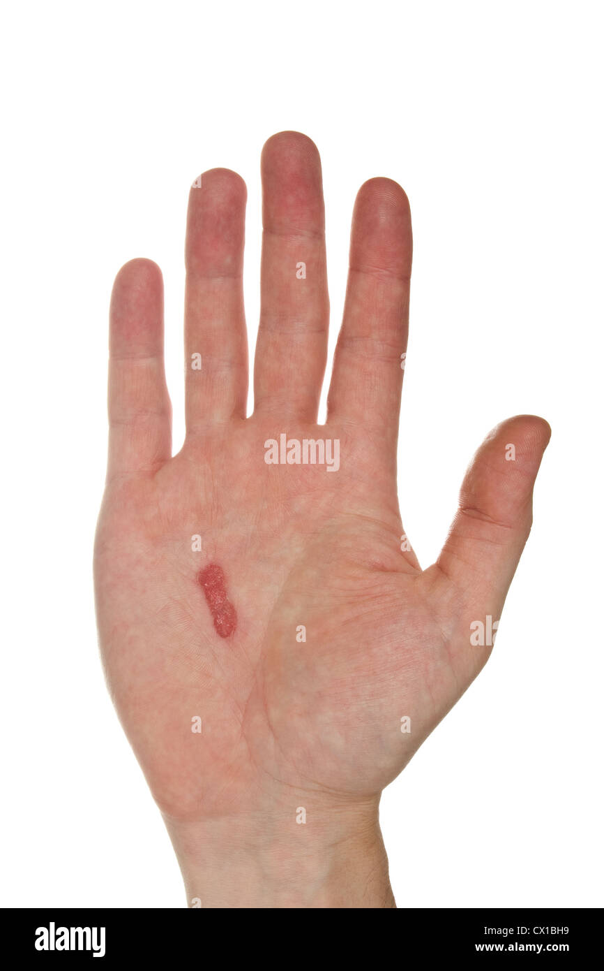 Callus Hand