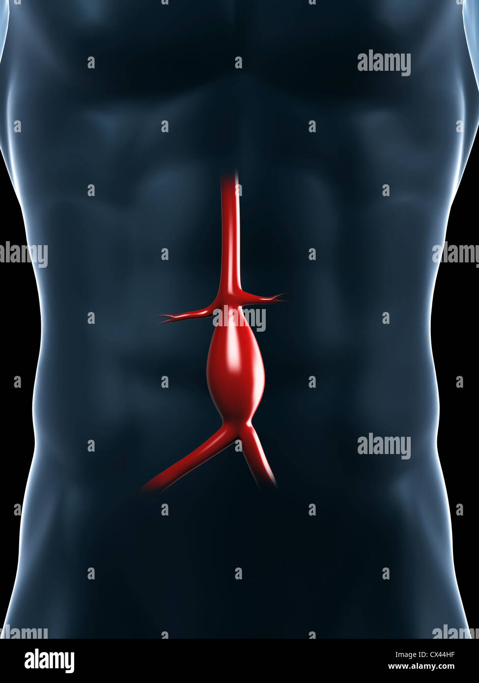 Abdominal aorta aneurysm hi-res stock photography and images - Alamy