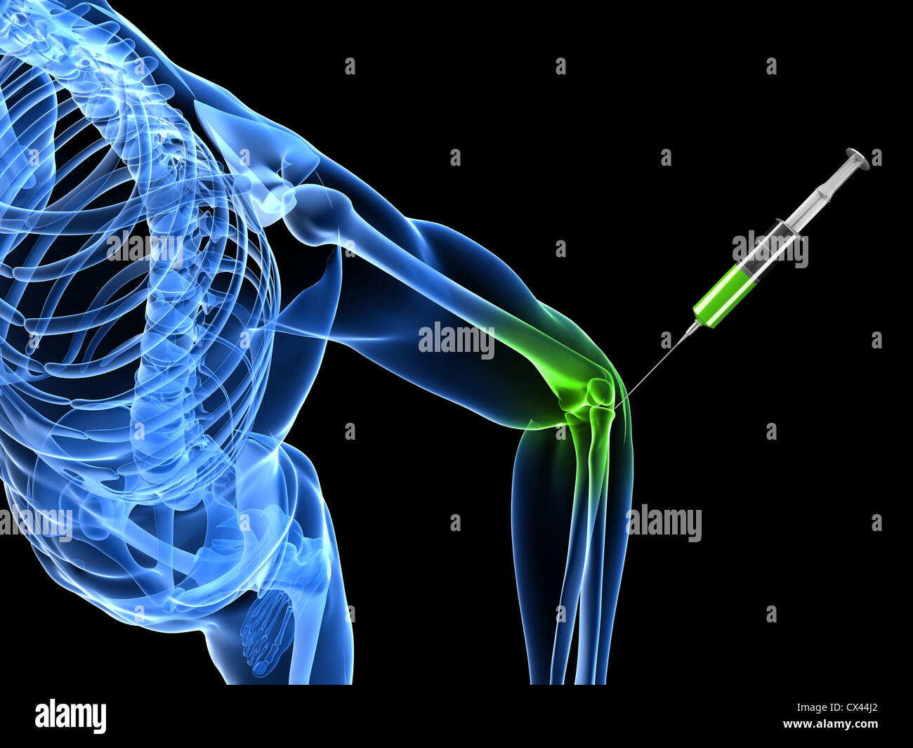 3d rendered illustration showing an elbow joint injection Stock Photo ...