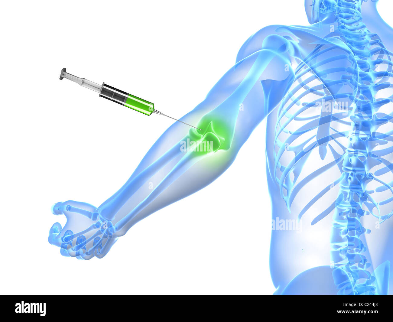 3d rendered illustration showing an elbow joint injection Stock Photo ...