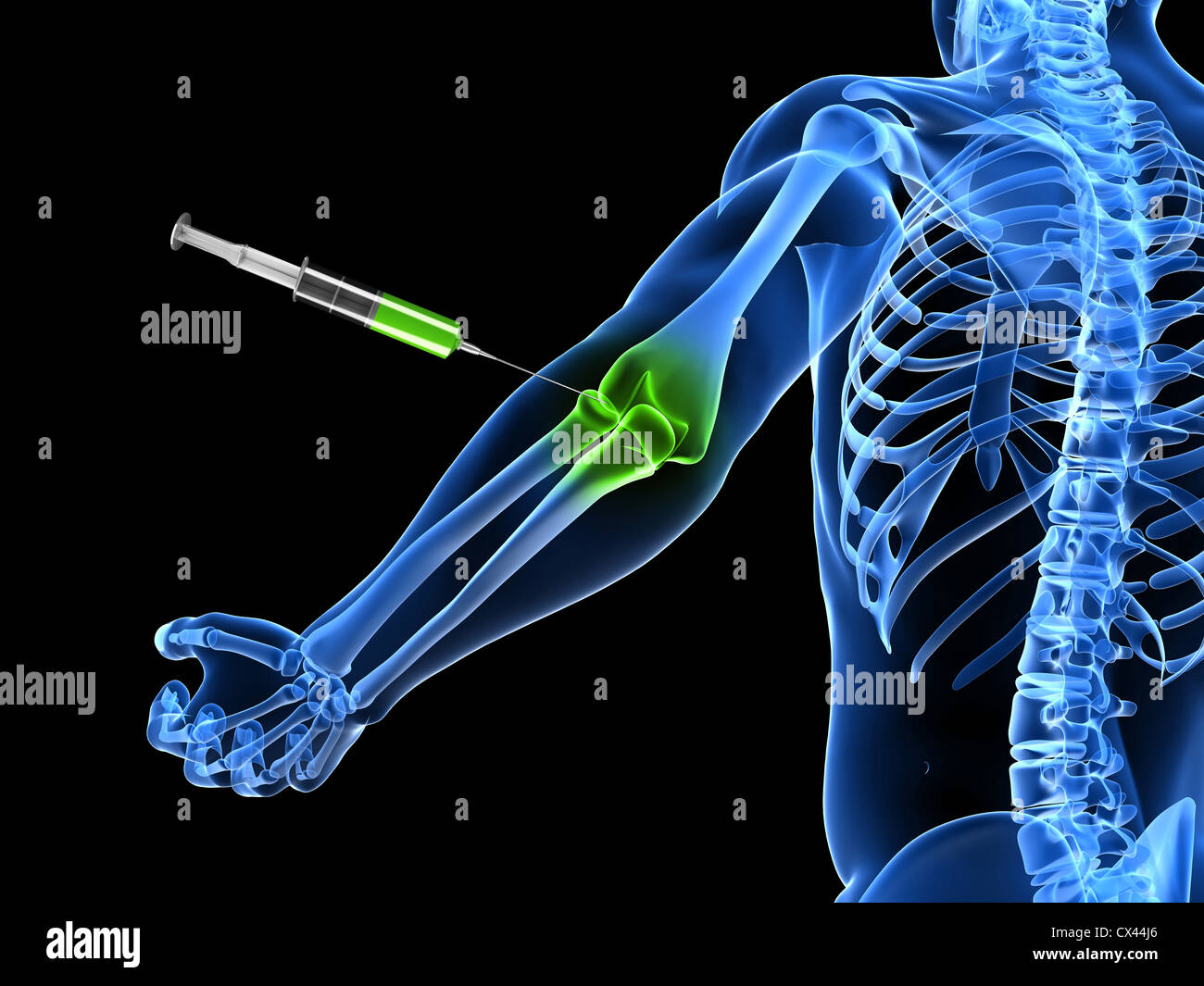 3d rendered illustration showing an elbow joint injection Stock Photo ...