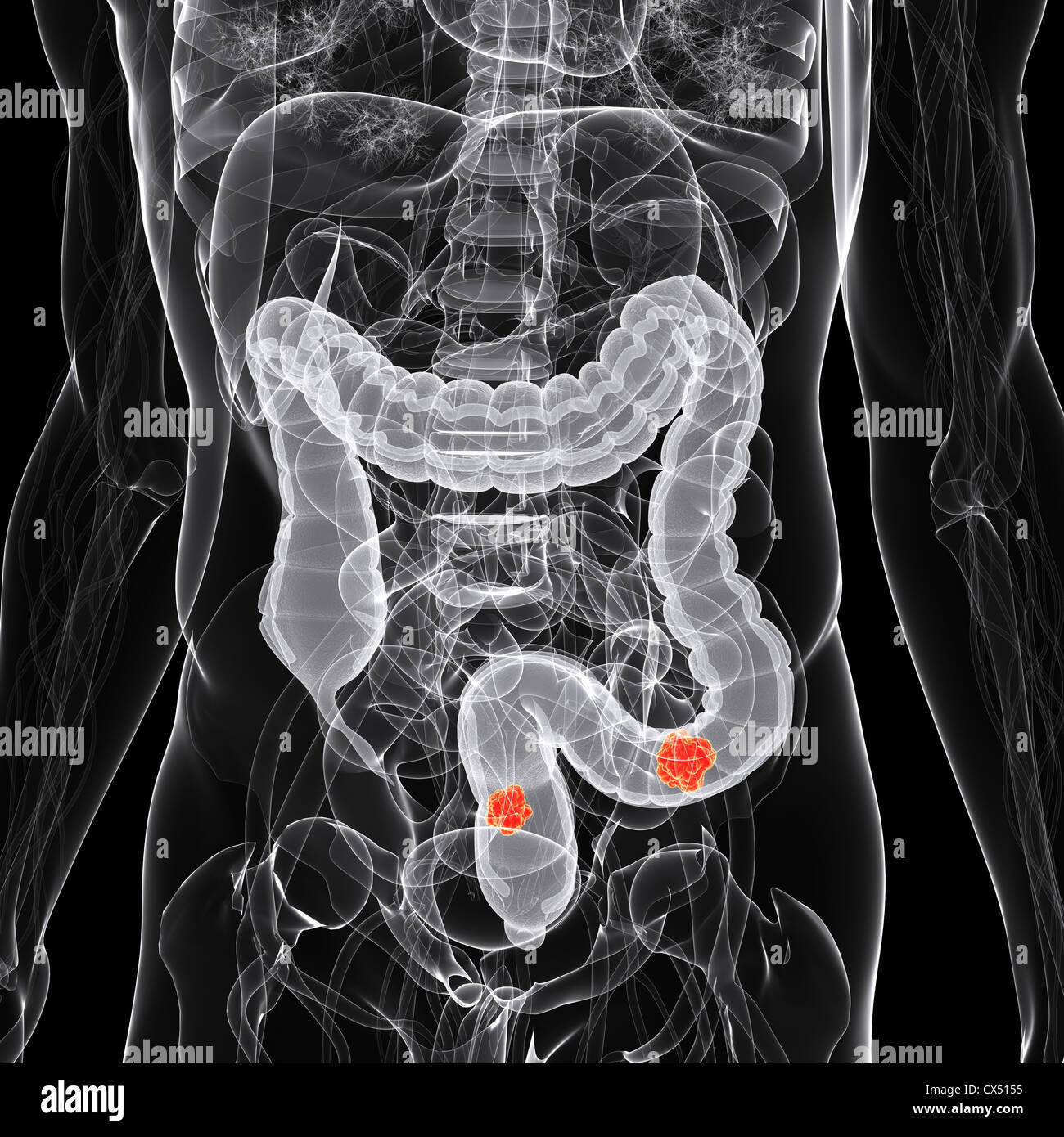 Cancer of the colon hi-res stock photography and images - Alamy