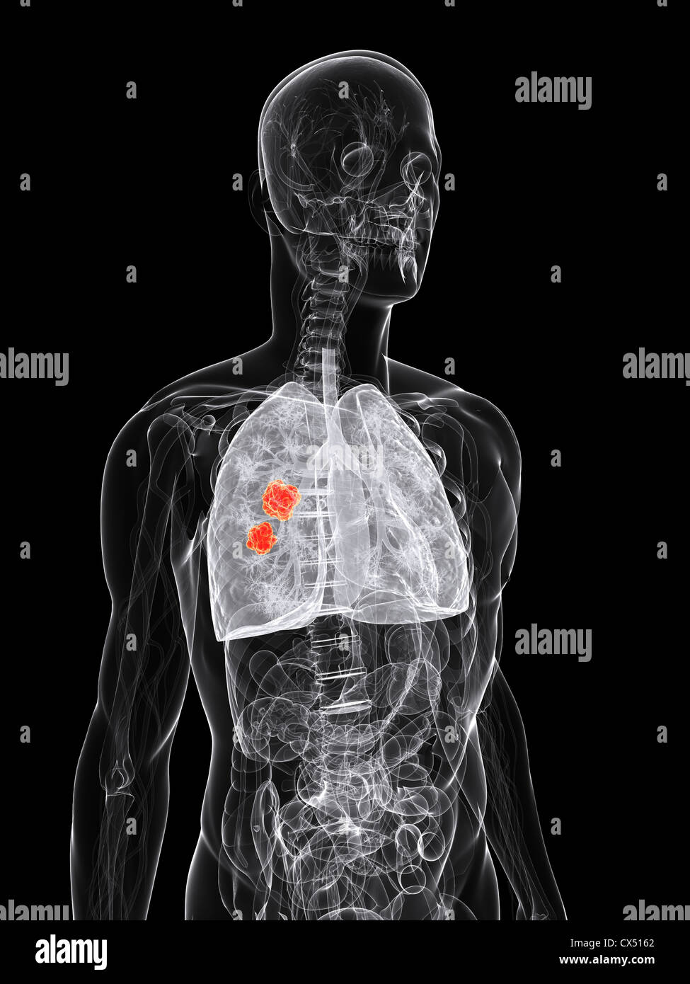 X ray lung cancer male hi-res stock photography and images - Alamy