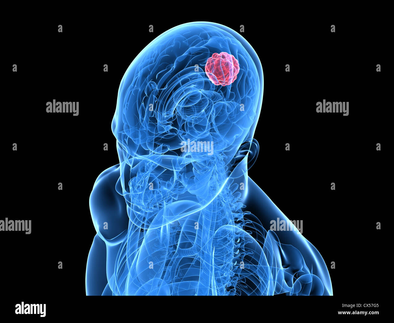 Head tumor hi-res stock photography and images - Alamy