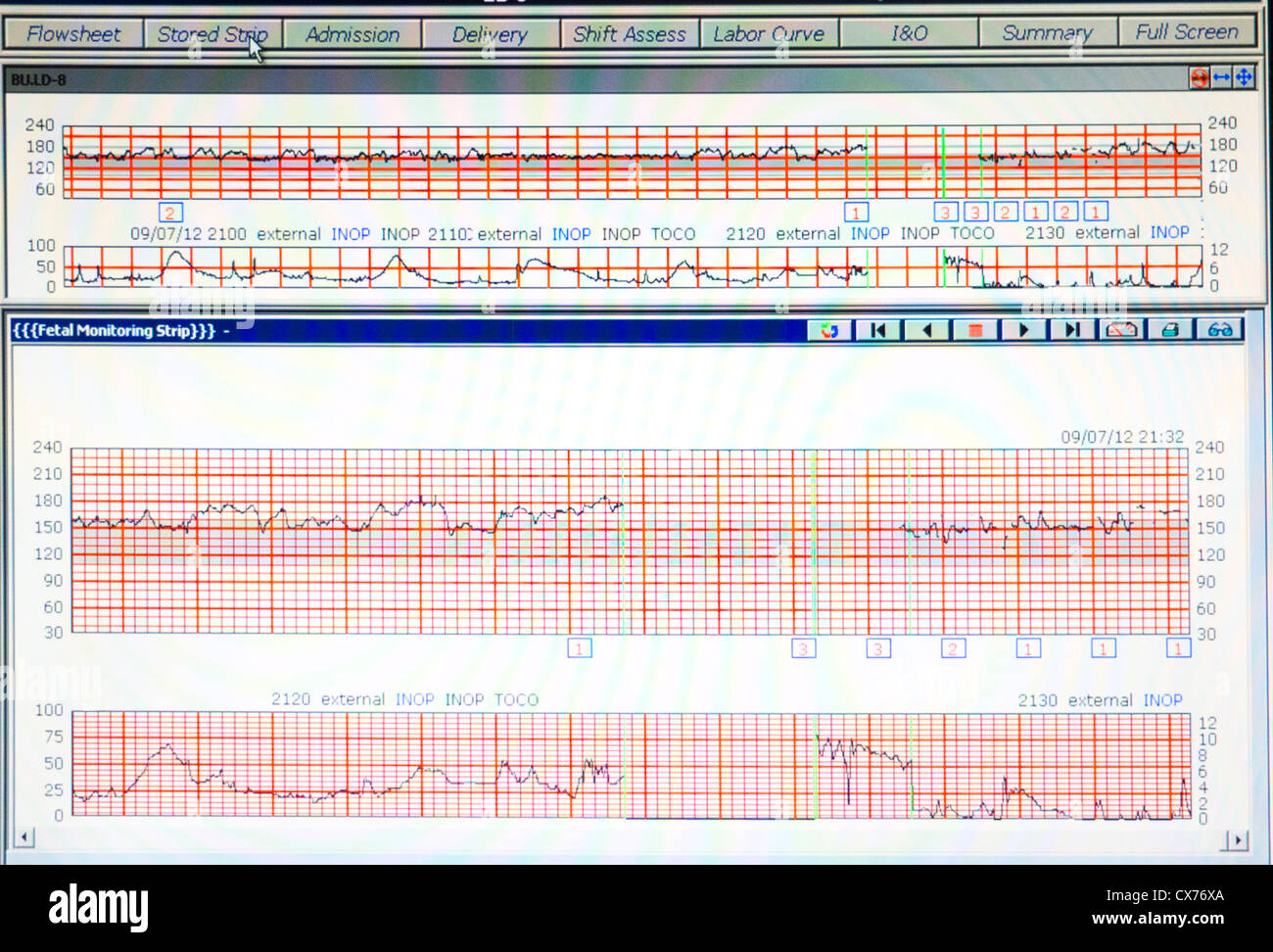 fetal monitoring results Stock Photo - Alamy