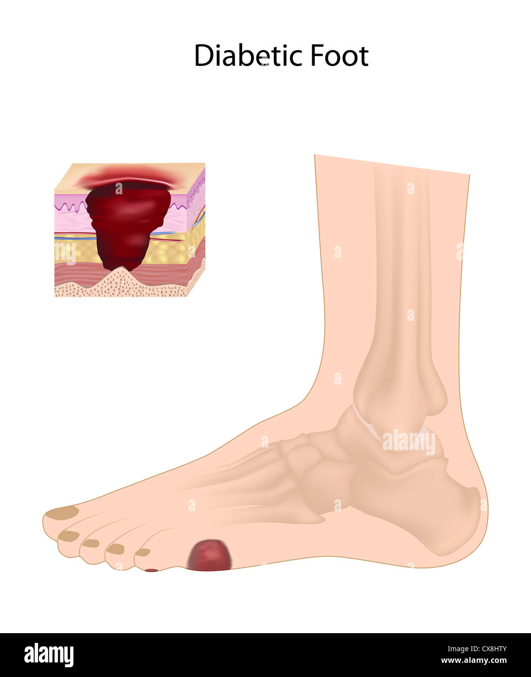 Diabetic Foot Stock Photos & Diabetic Foot Stock Images - Alamy