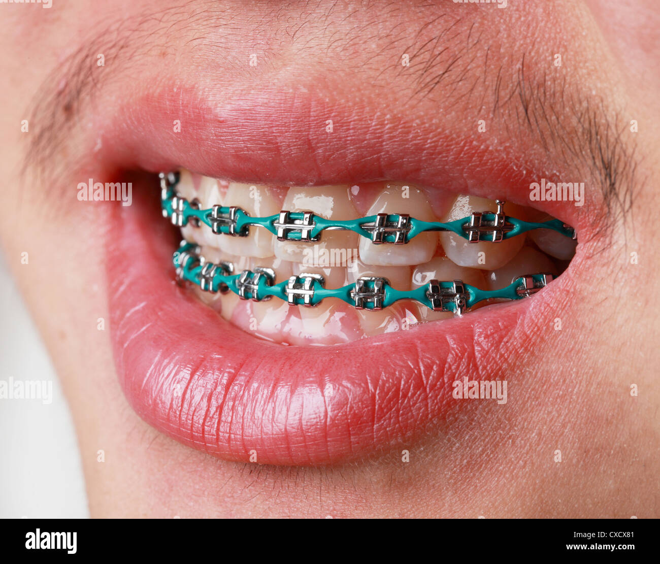Smile appearance braces teeth hi-res stock photography and images - Alamy
