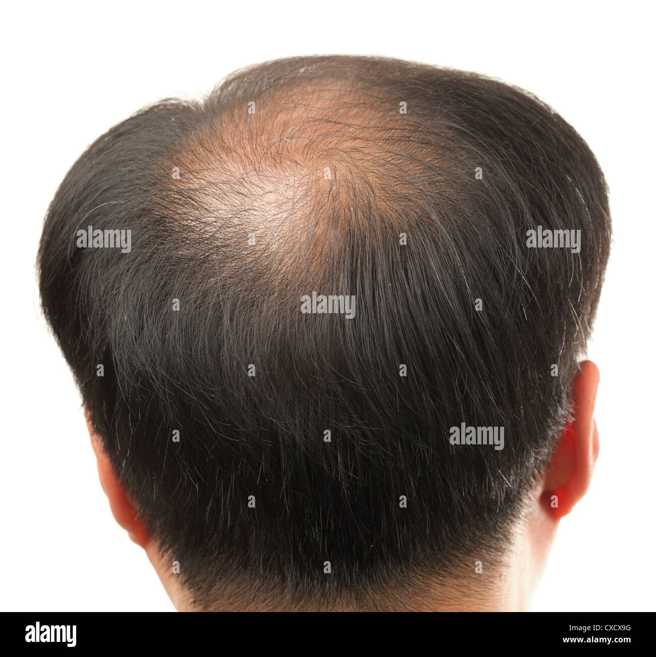 Hair loss hi-res stock photography and images - Alamy