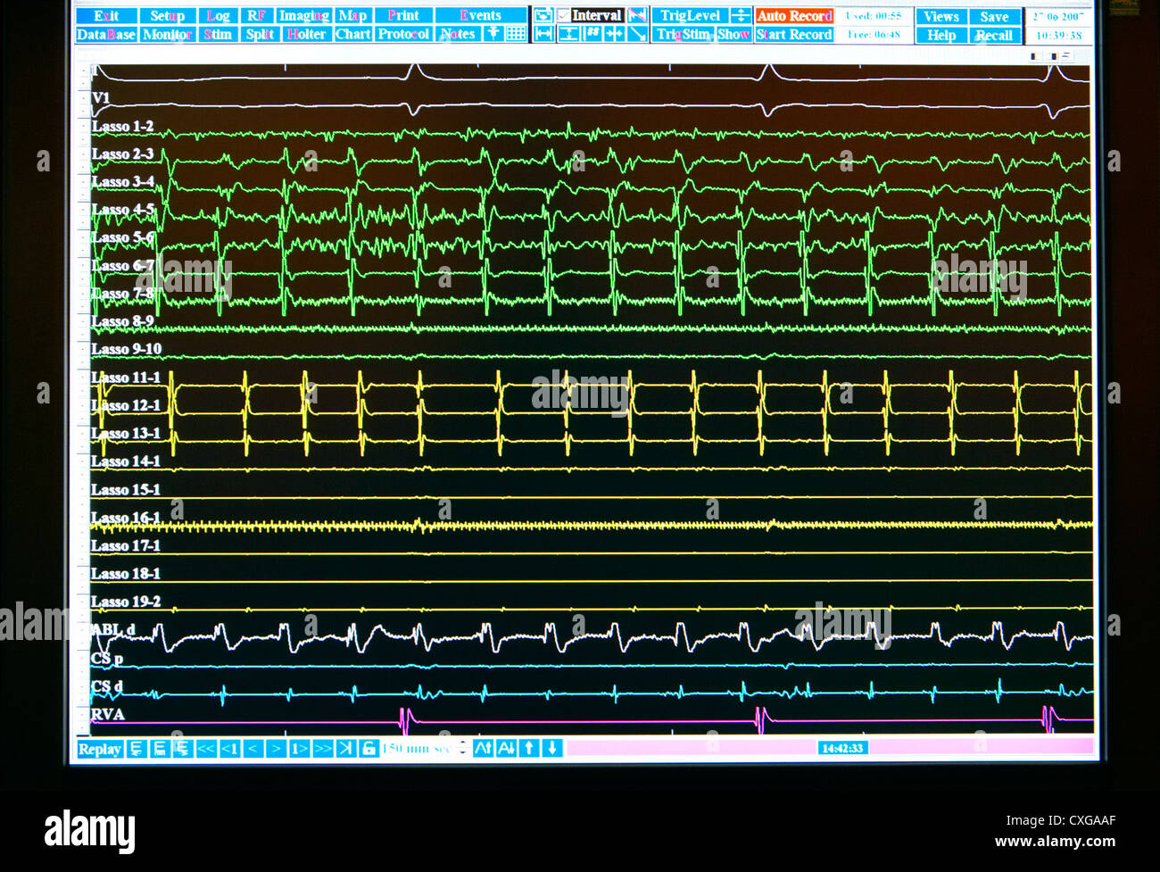 Berlin, colored lines of an ECG on a monitor Stock Photo - Alamy