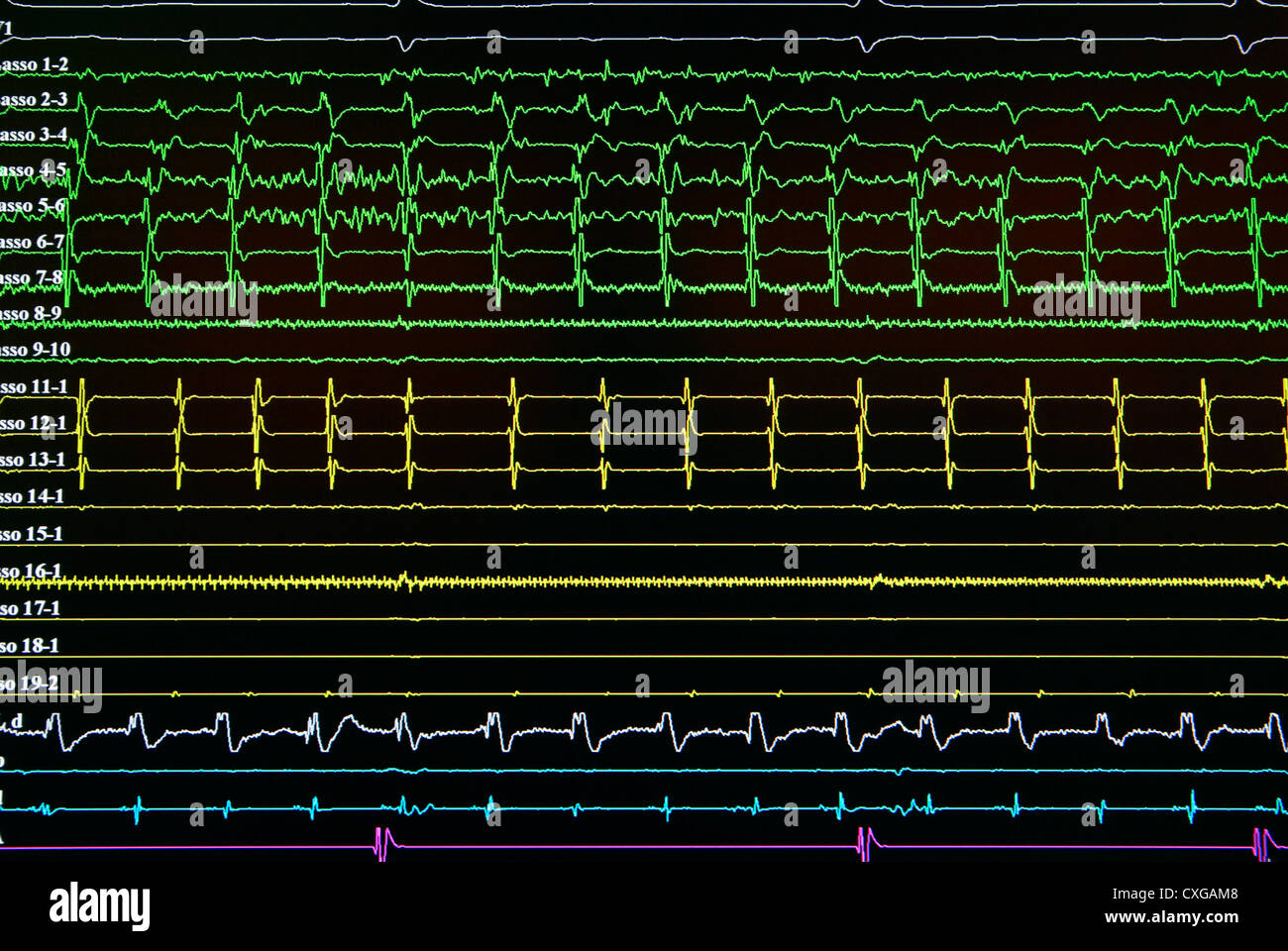 Berlin, colored lines of an ECG on a monitor Stock Photo - Alamy