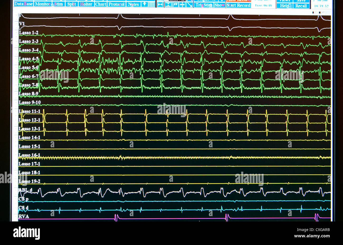 Berlin, colored lines of an ECG on a monitor Stock Photo - Alamy