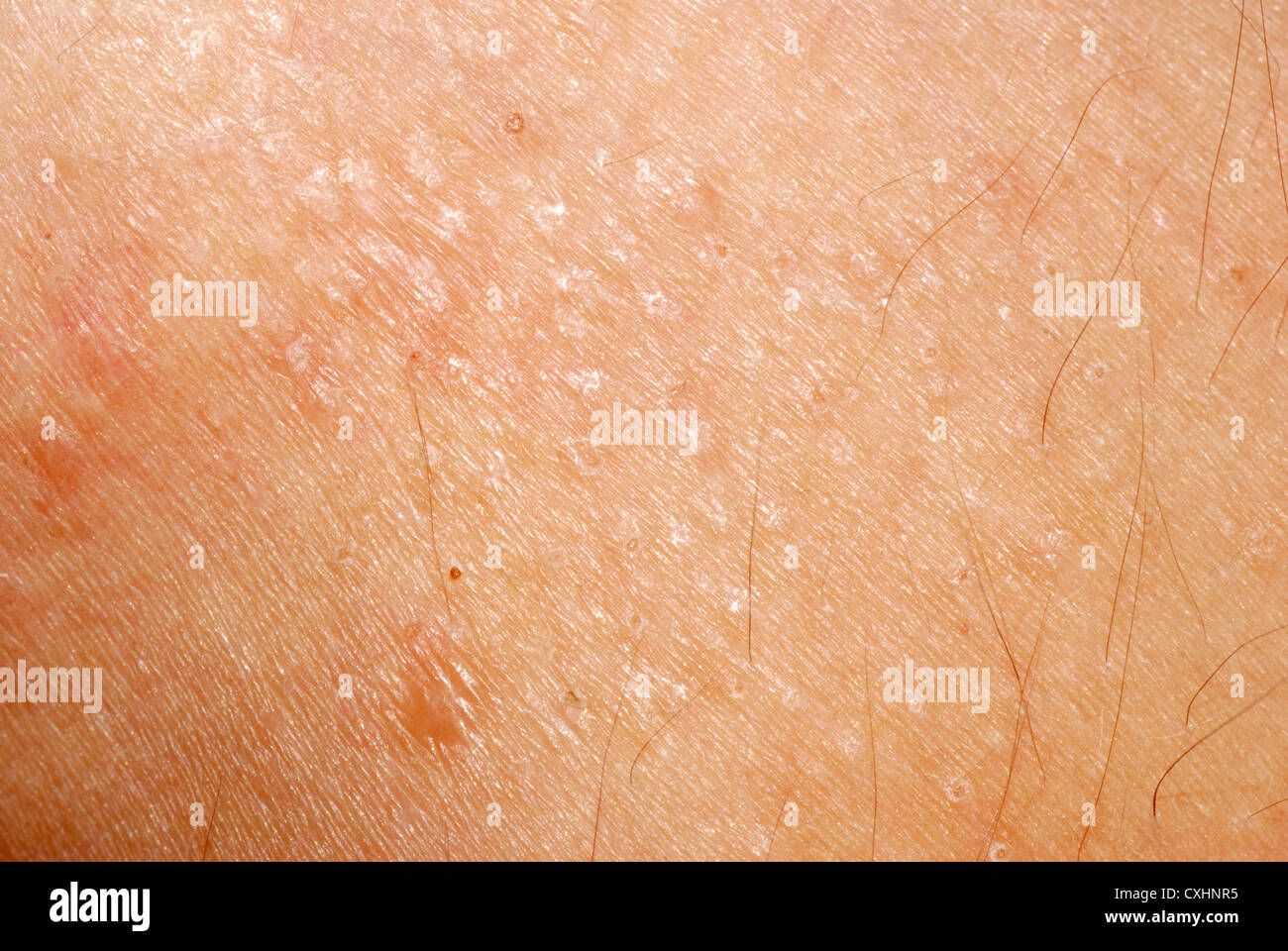 allergic rash dermatitis skin texture Stock Photo - Alamy