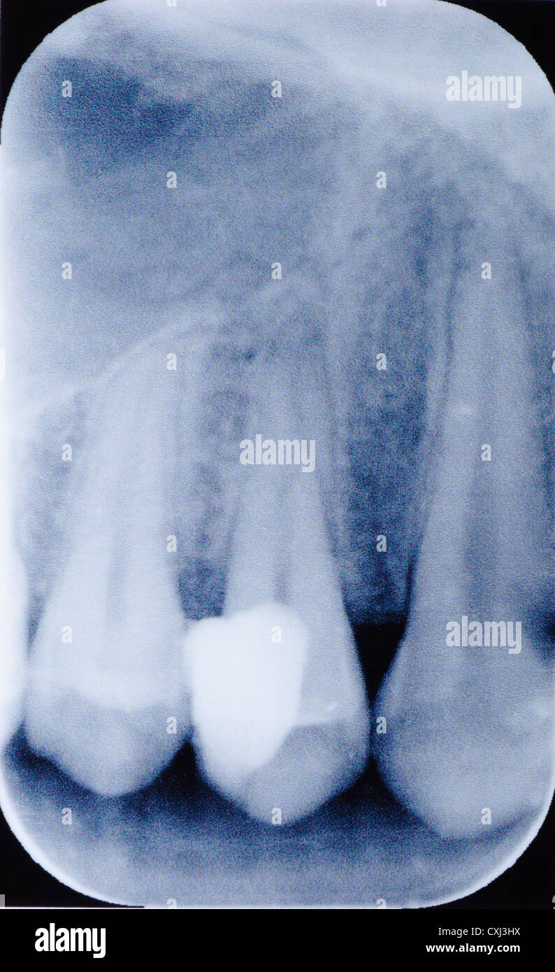 Jaw fracture hi-res stock photography and images - Alamy