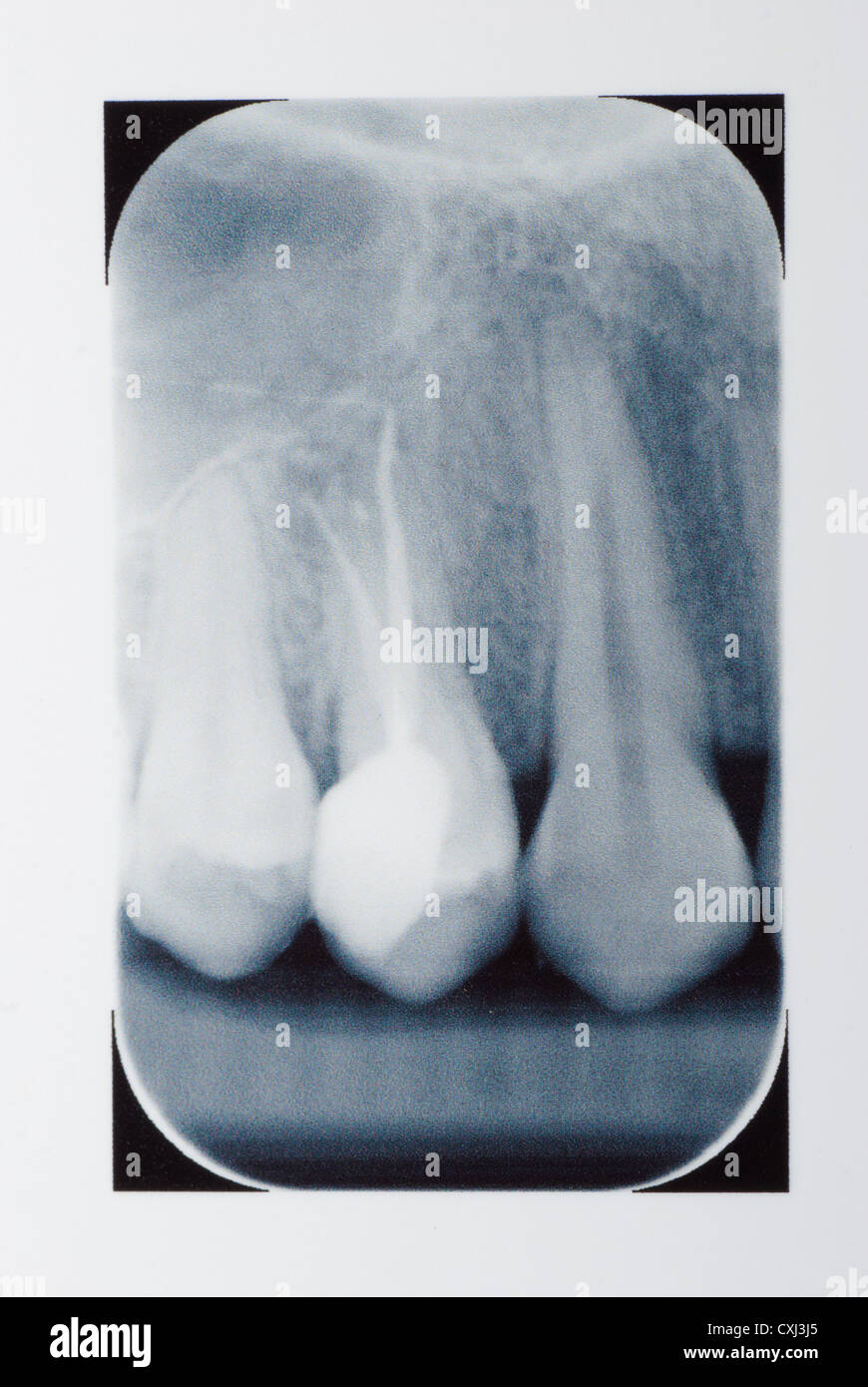 Tooth fracture hi-res stock photography and images - Alamy