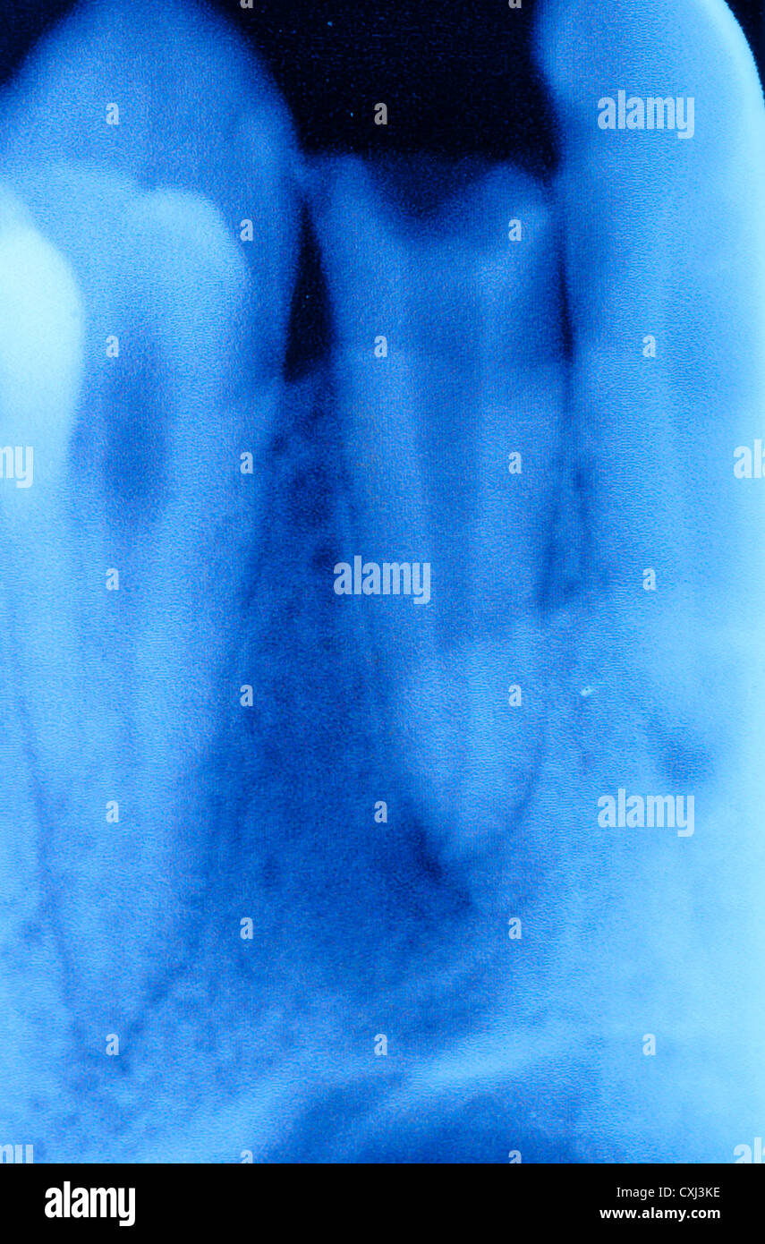 Dental x ray examination hi-res stock photography and images - Alamy