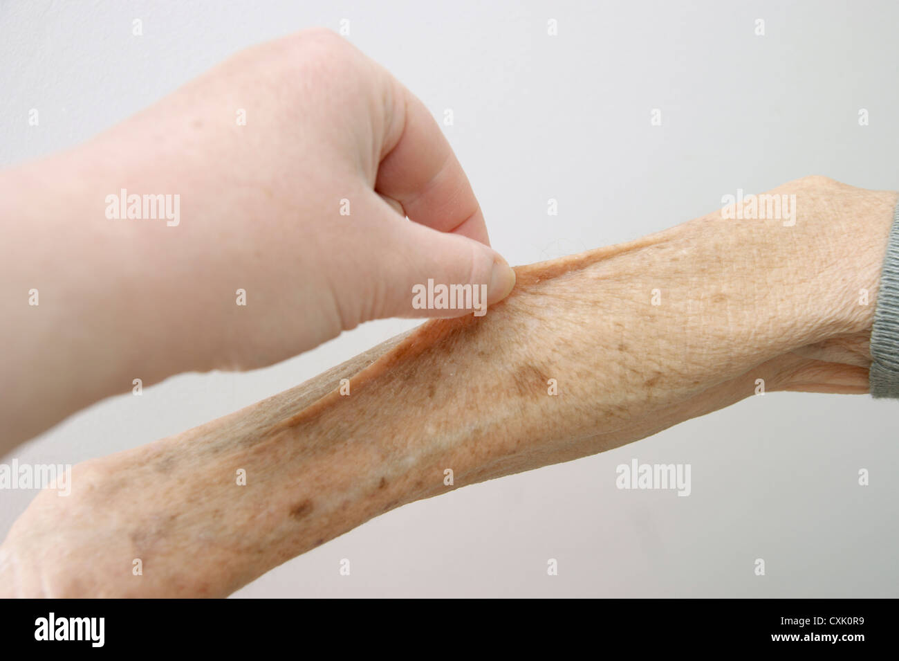 Elderly woman having forearm pinched to illustrate a Skin Turgor ...