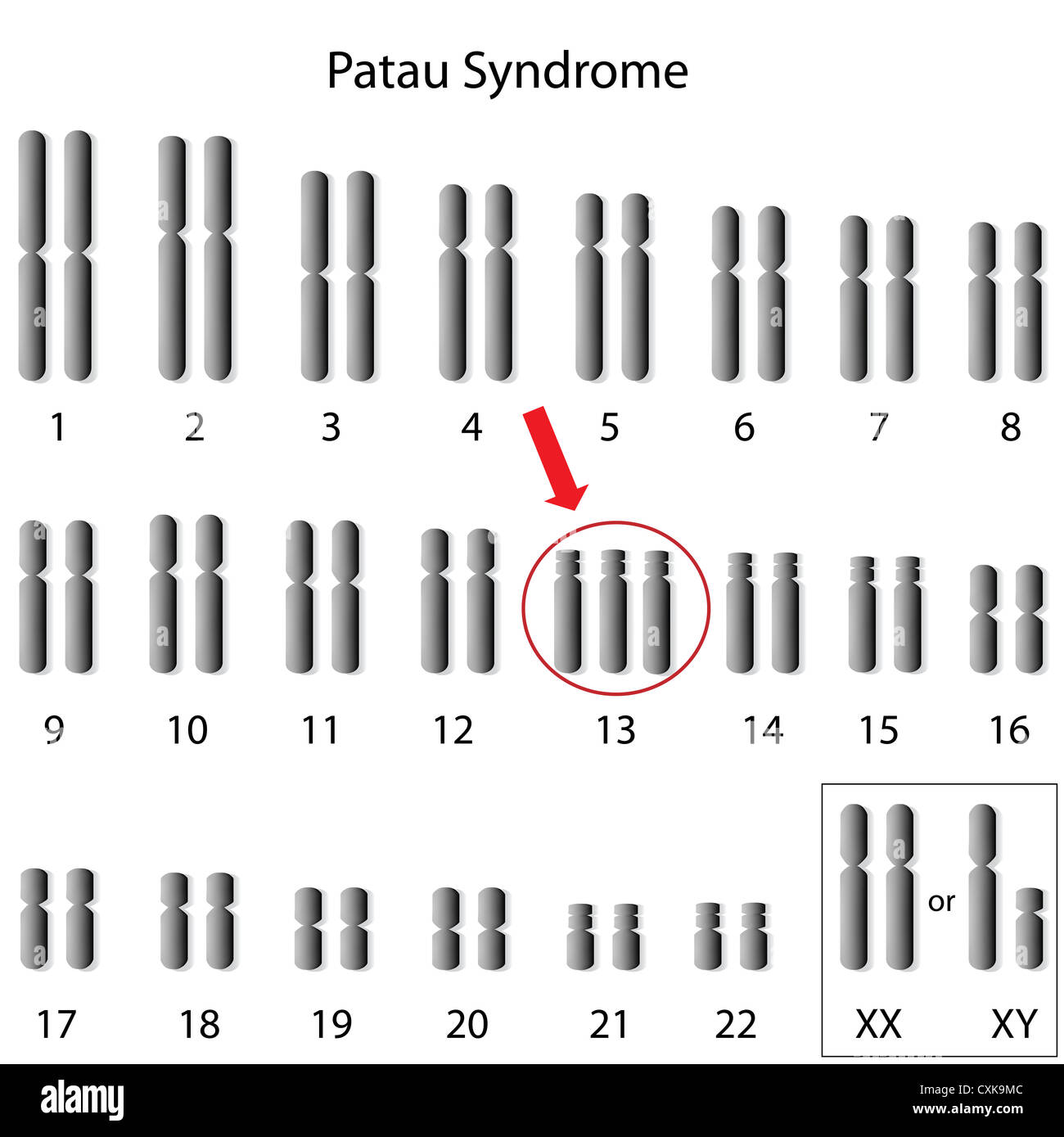 Patau syndrome, trisomy 13 Stock Photo - Alamy