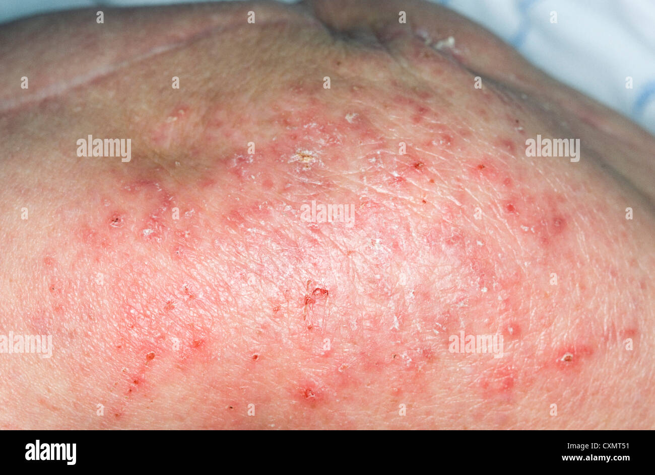 Erythema and inflammation of the skin hi-res stock photography and ...