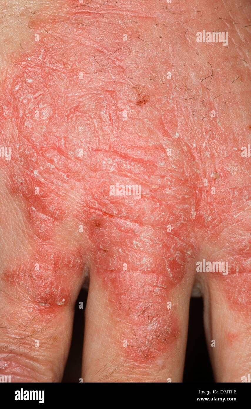 Psoriatic Plaque High Resolution Stock Photography and Images - Alamy