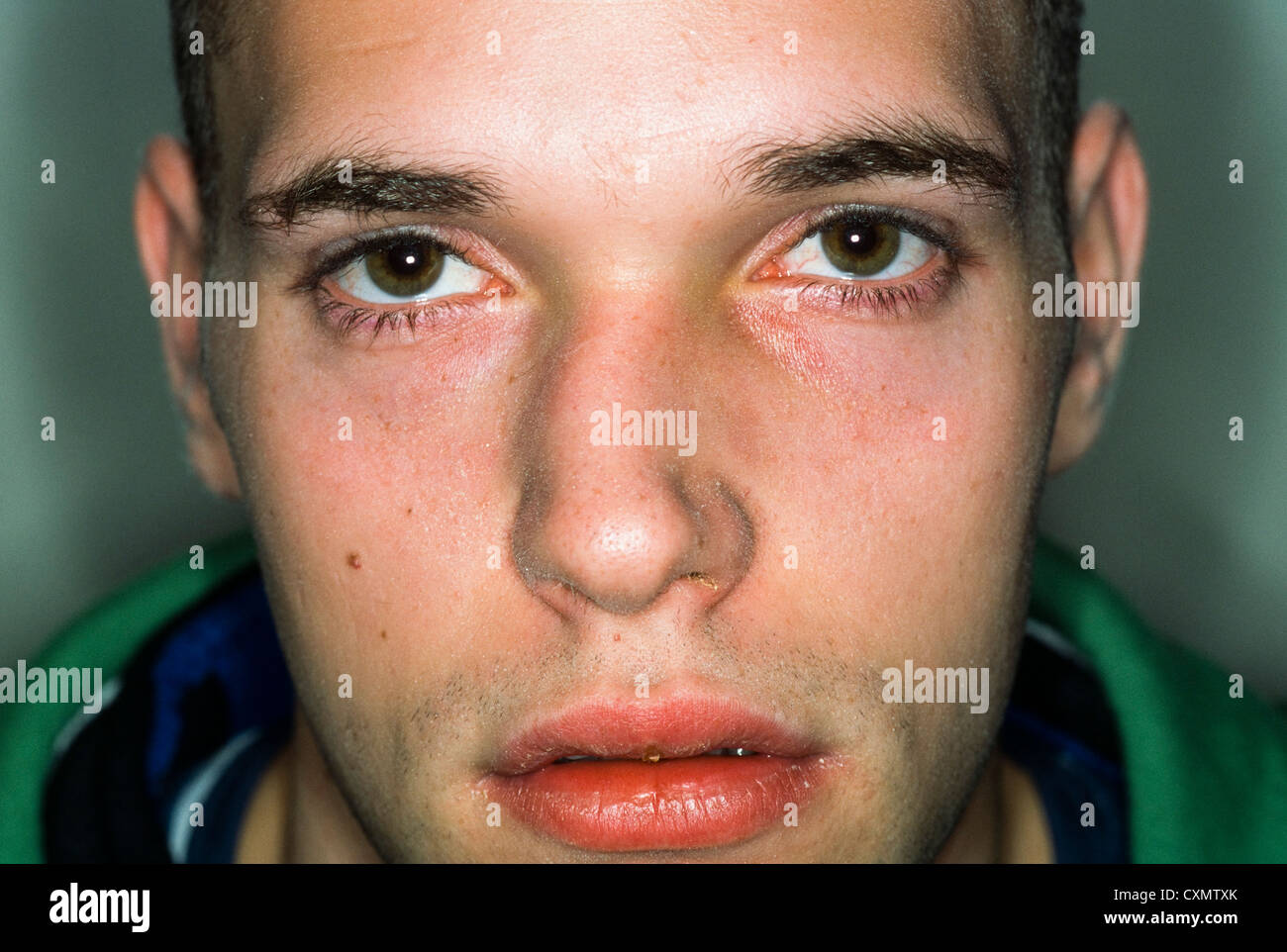 Nasal septum fracture hi-res stock photography and images - Alamy