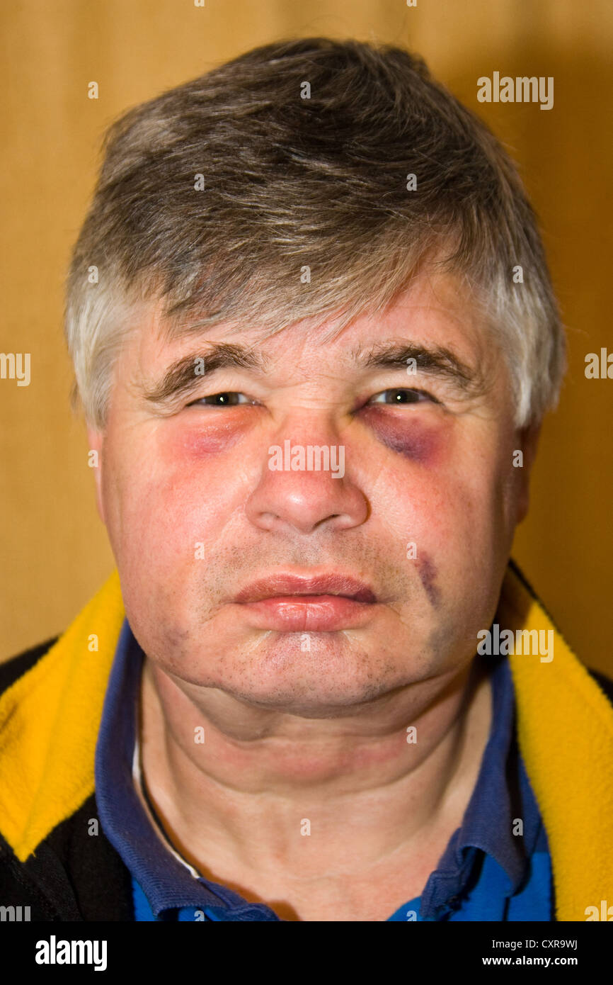 Facial injuries showing black eyes and bruising on a man as a result of ...