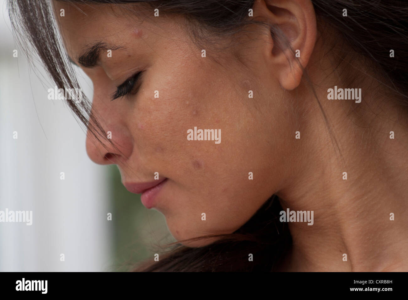 woman with blemished skin Stock Photo - Alamy