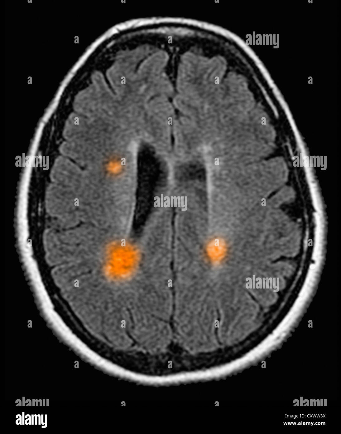 Multiple sclerosis mri hi-res stock photography and images - Alamy Multiple sclerosis mri hi-res stock photography and images - Alamy
