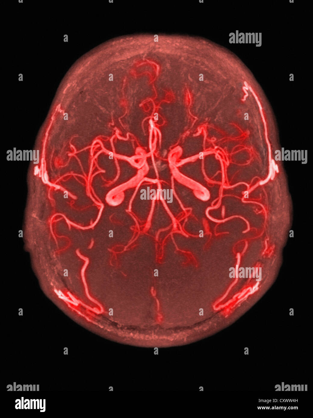 Normal arterial blood supply to the brain Stock Photo - Alamy