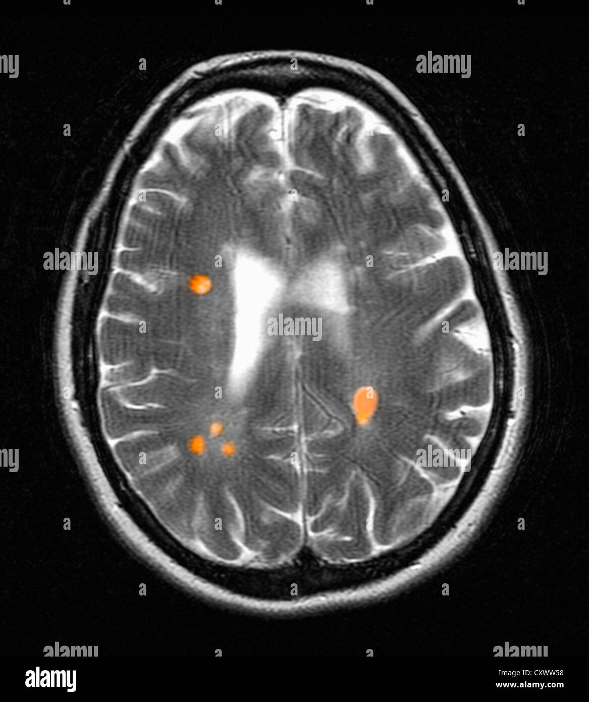 Mri brain multiple sclerosis hi-res stock photography and images - Alamy