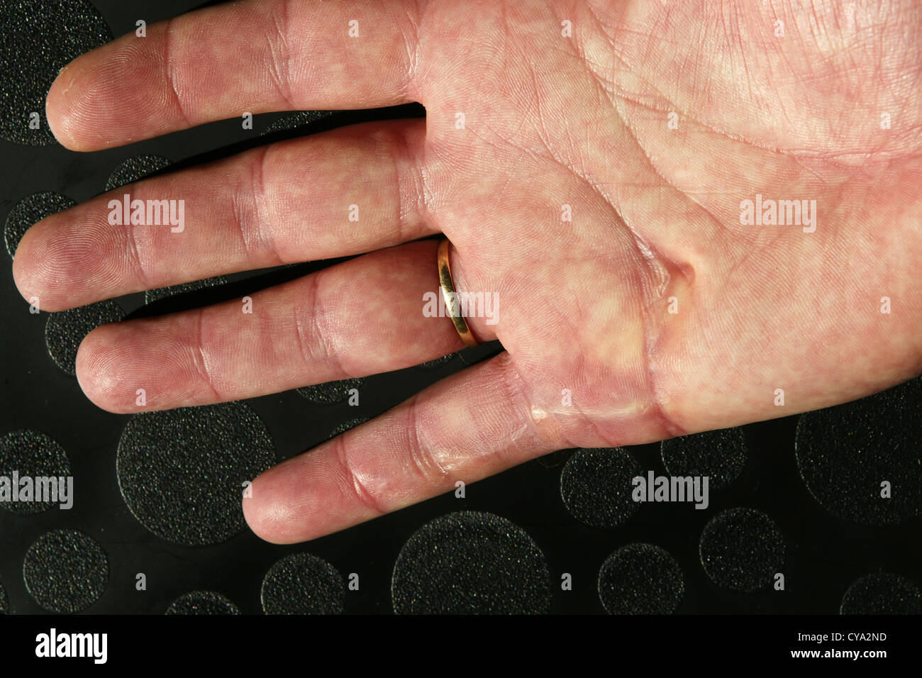 Dupuytrens contracture hi-res stock photography and images - Alamy
