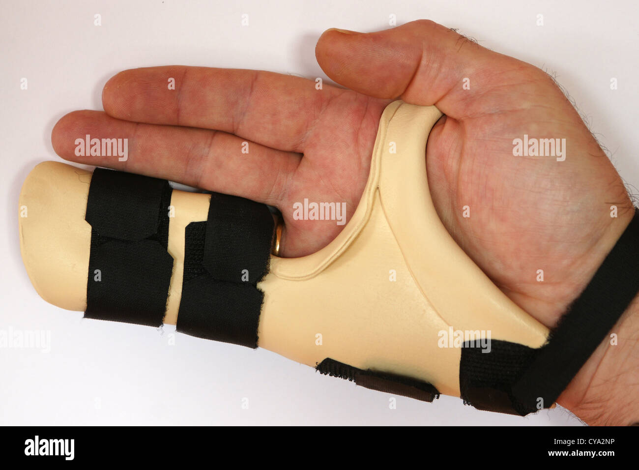 Hand Splint For Dupuytren's Contracture Purchase Cheap | bustanica.ae
