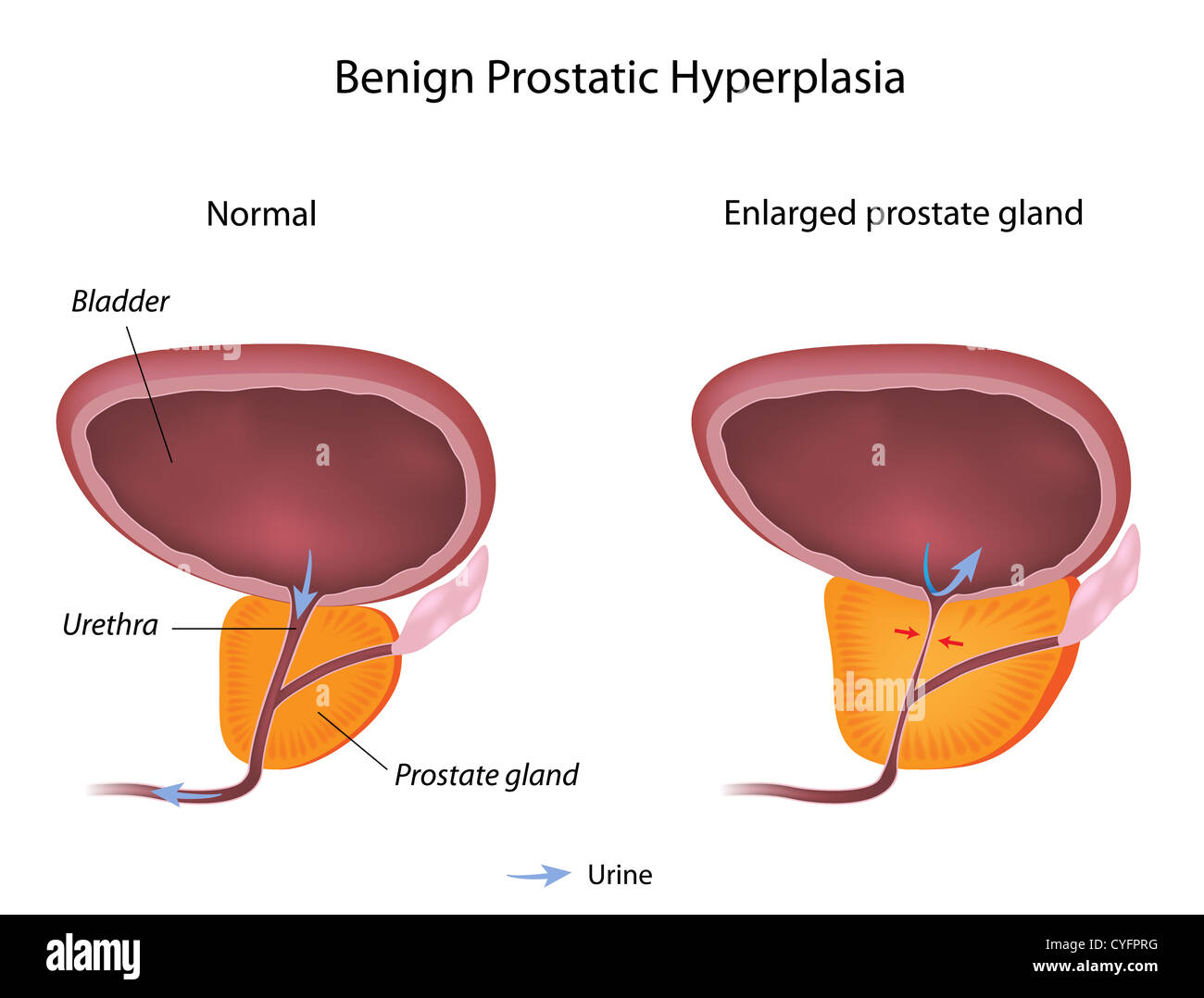 Benign prostatic hyperplasia (BPH Stock Photo - Alamy