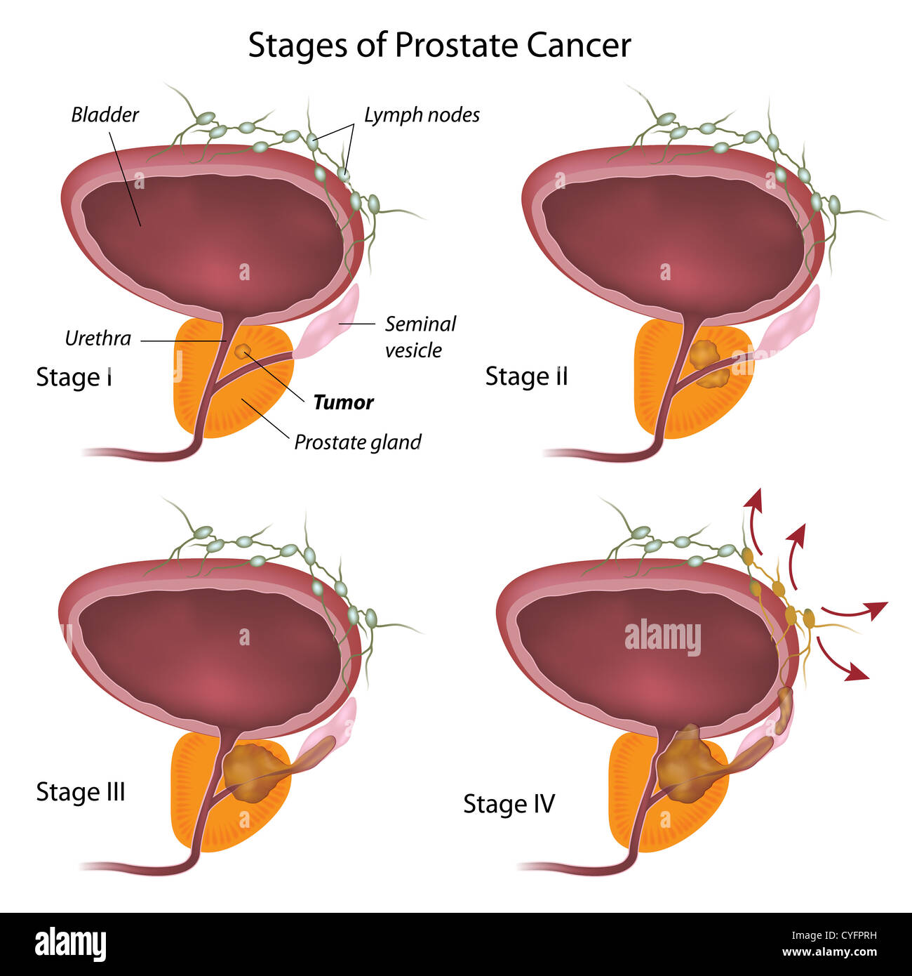 Stages of prostate cancer Stock Photo - Alamy