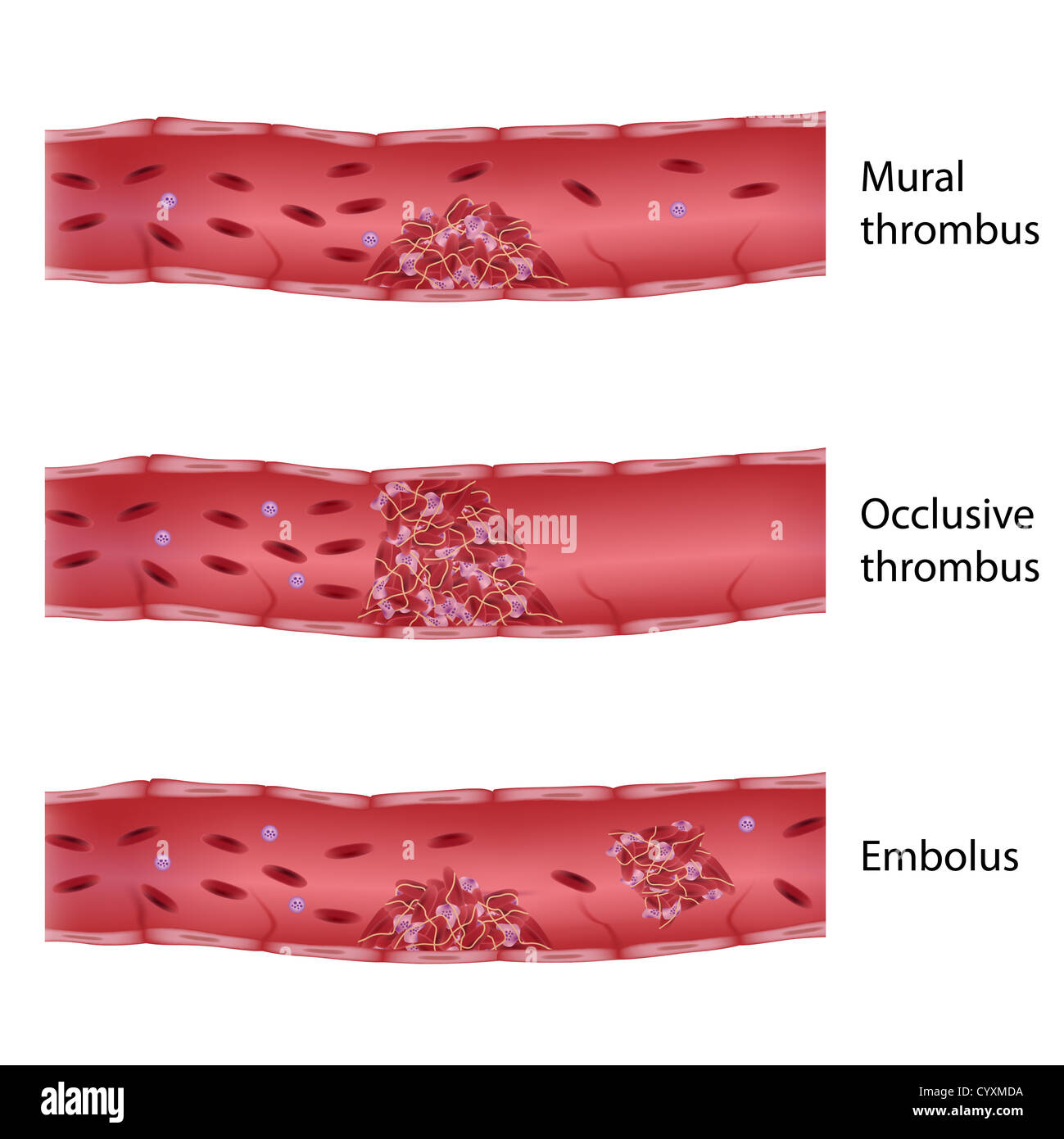 Thrombus Cut Out Stock Images & Pictures - Alamy