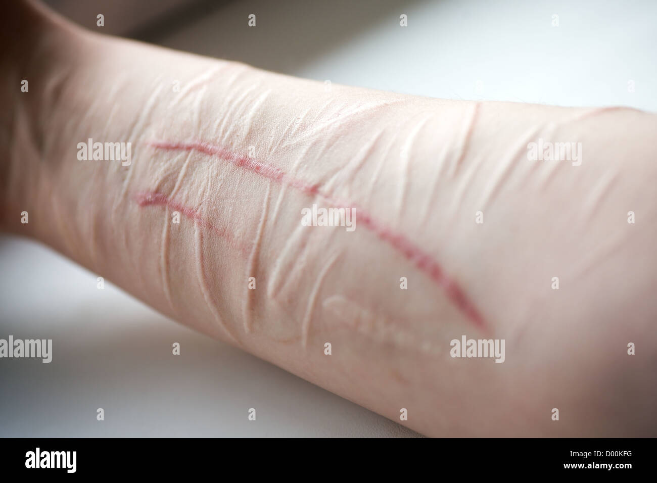 hand with fresh and old scars of self destroyer Stock Photo - Alamy