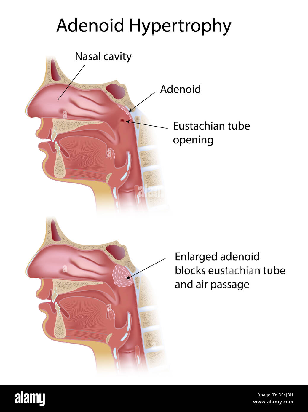 Adenoid hypertrophy Stock Photo - Alamy Adenoid hypertrophy Stock Photo - Alamy