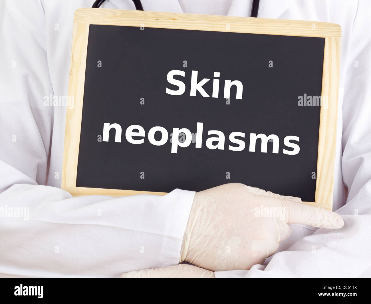 Doctor shows information on blackboard: skin neoplasms Stock Photo - Alamy