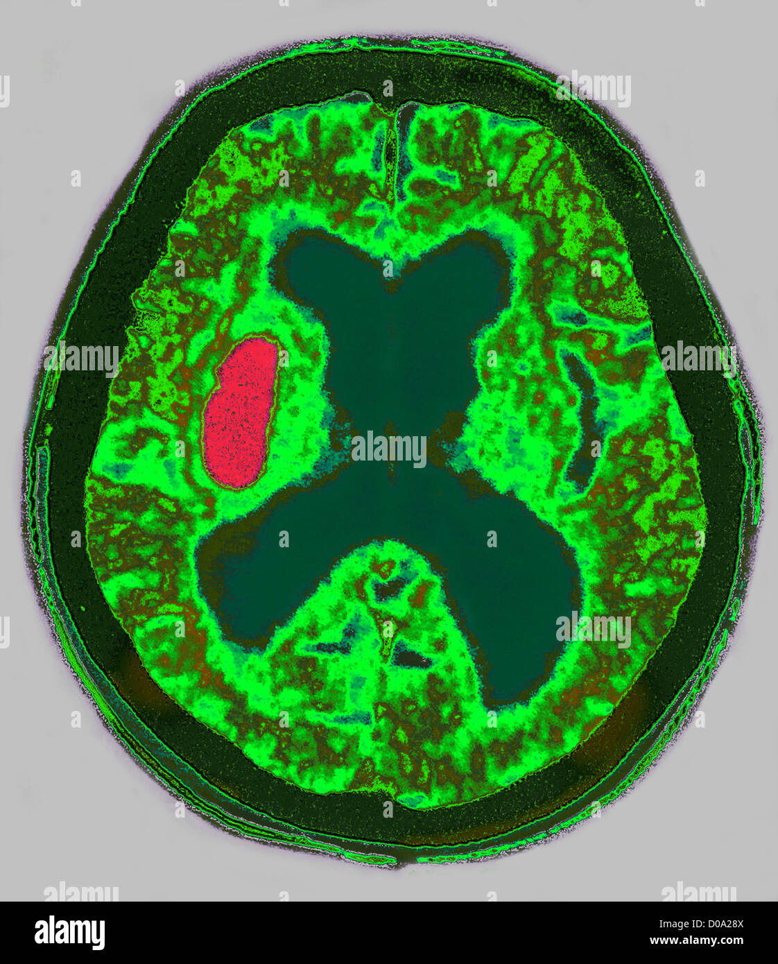 HEMORRHAGE, BRAIN SCAN Stock Photo - Alamy