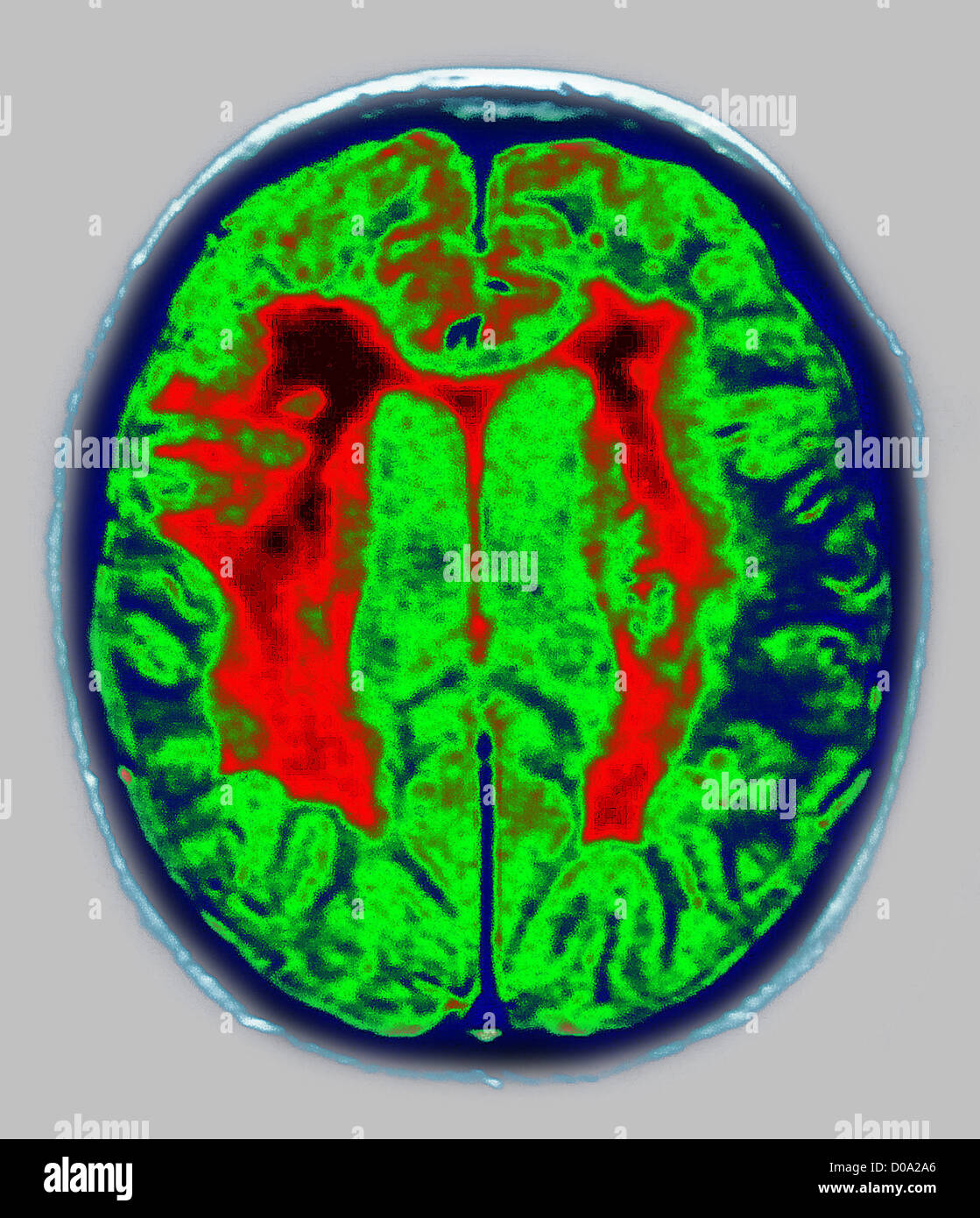 Melas syndrome hi-res stock photography and images - Alamy