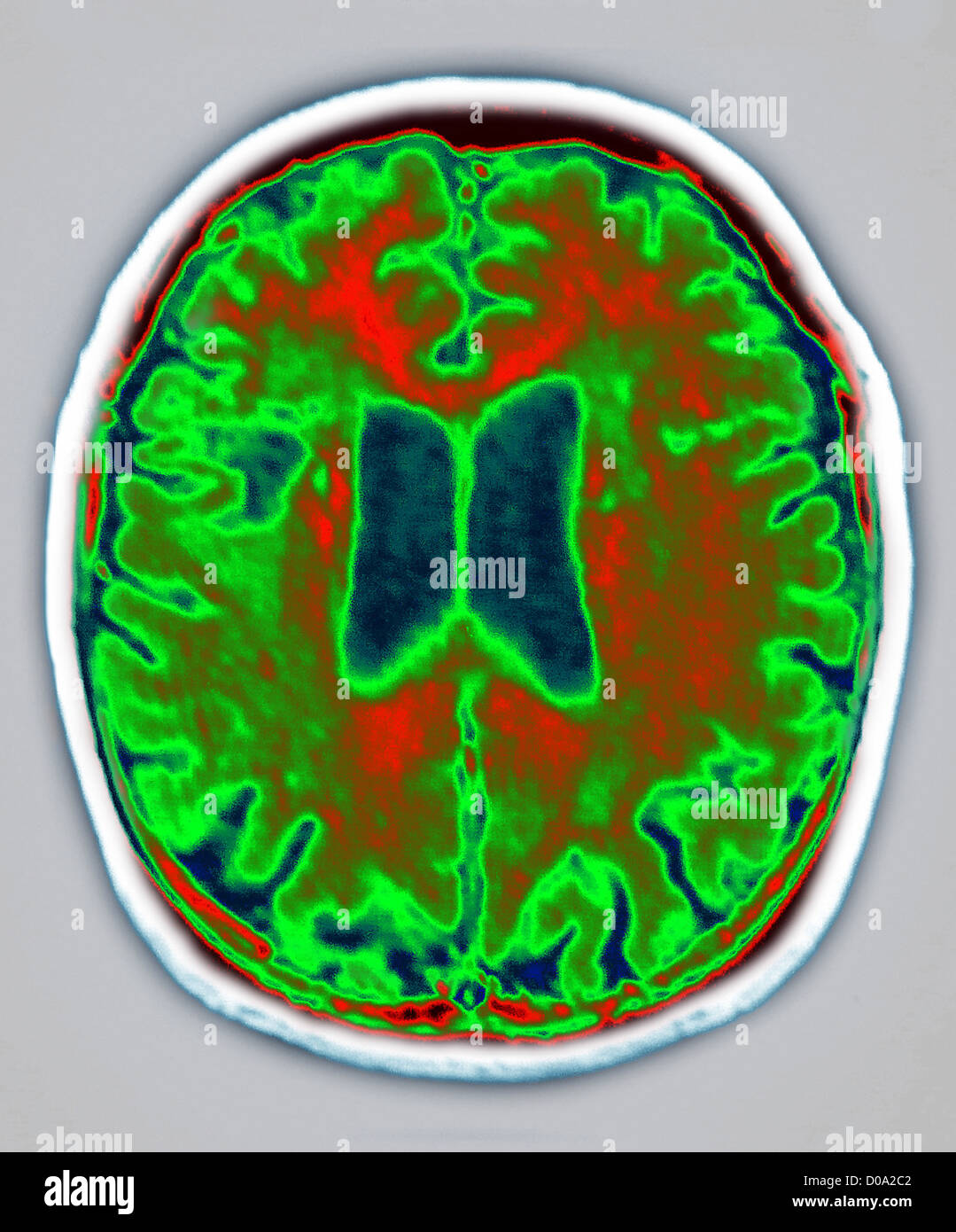 Melas syndrome hi-res stock photography and images - Alamy