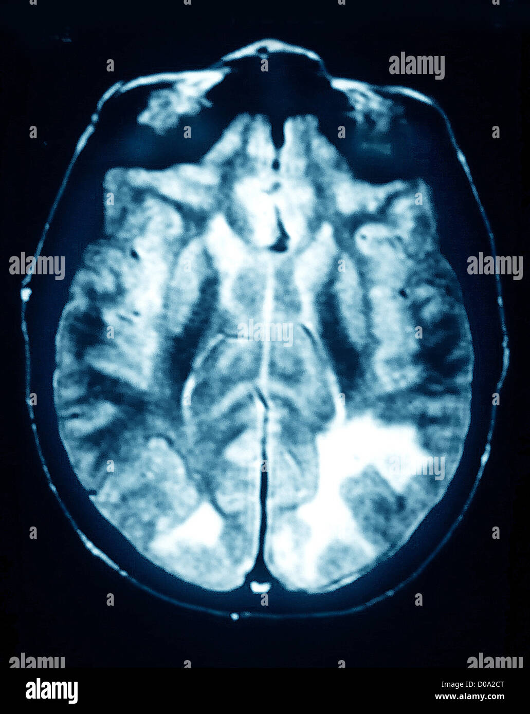 MELAS SYNDROME Stock Photo - Alamy