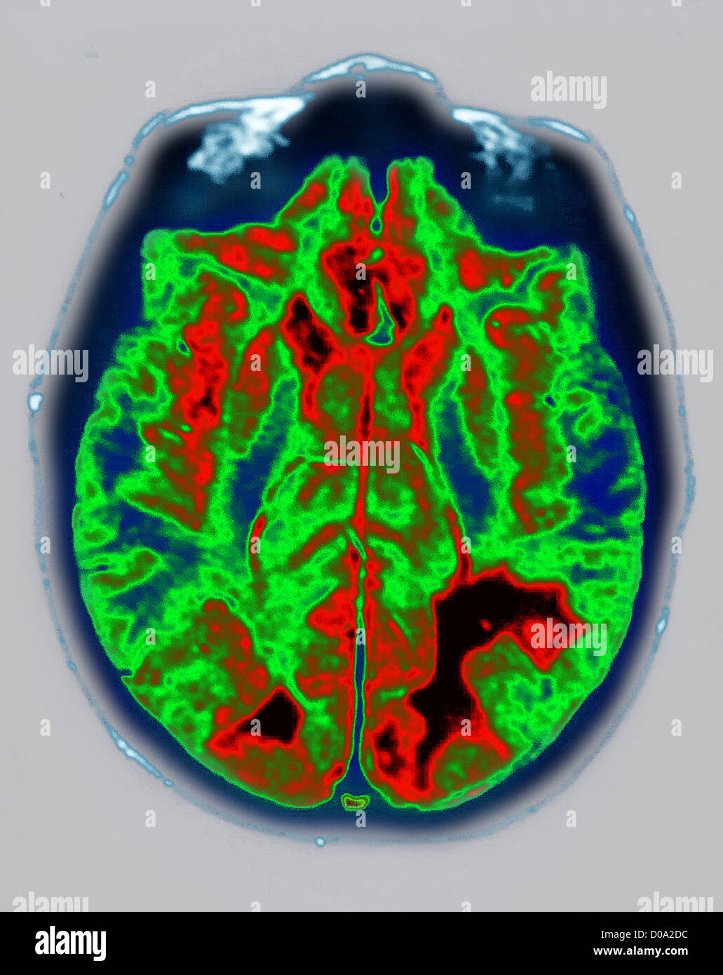 MELAS SYNDROME Stock Photo - Alamy