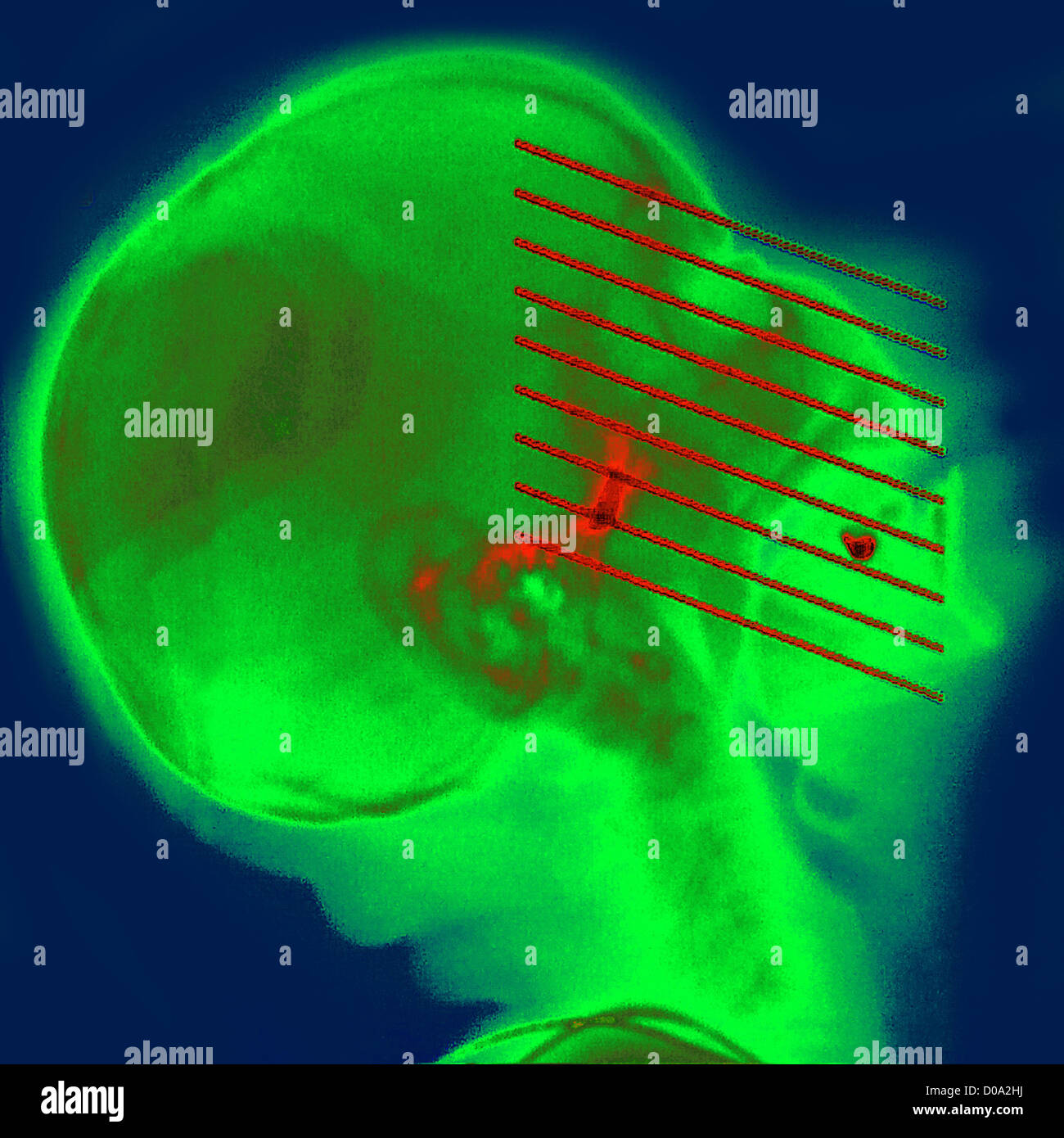 Normal skull x ray hi-res stock photography and images - Alamy