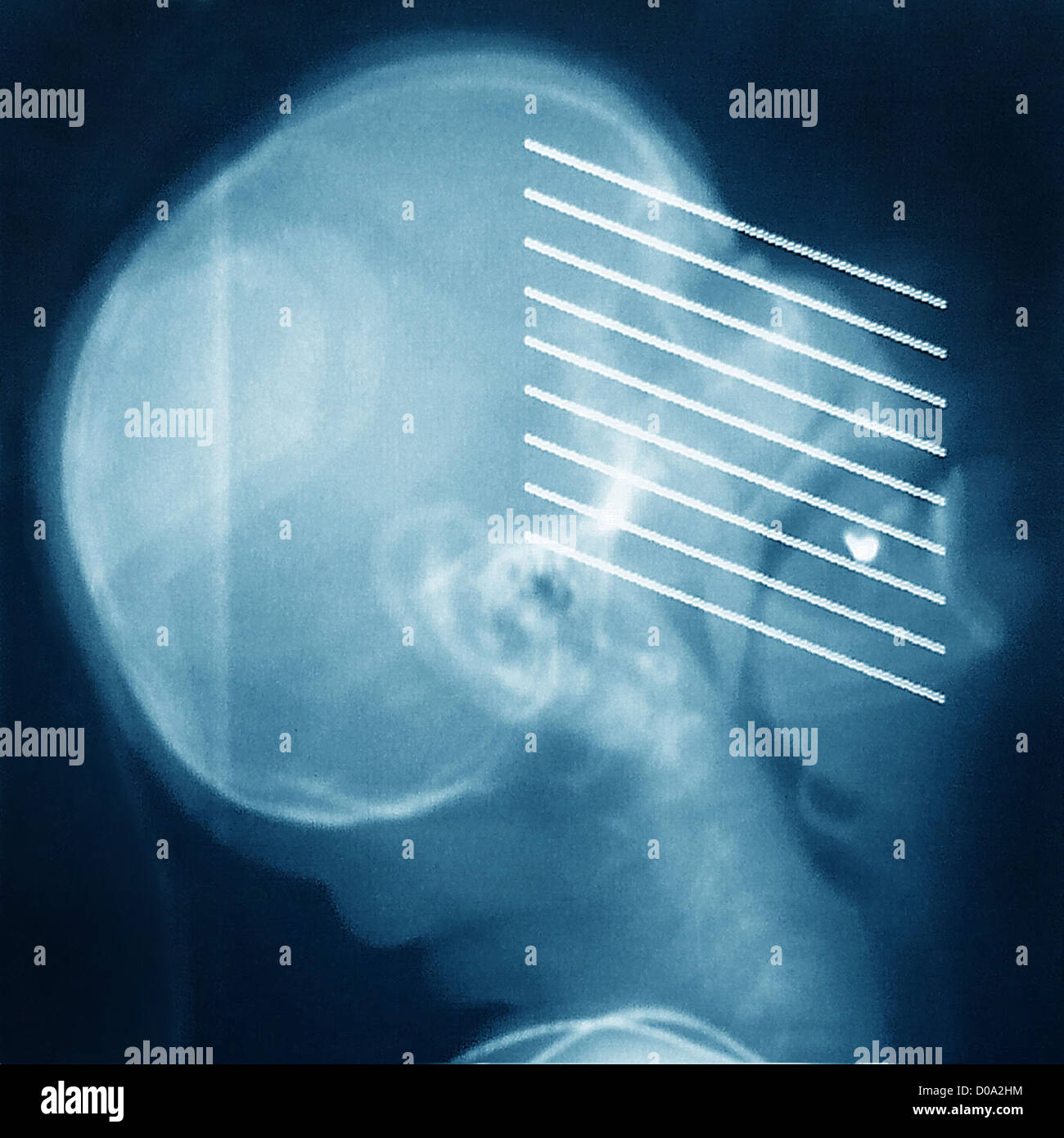 Normal skull x ray hi-res stock photography and images - Alamy