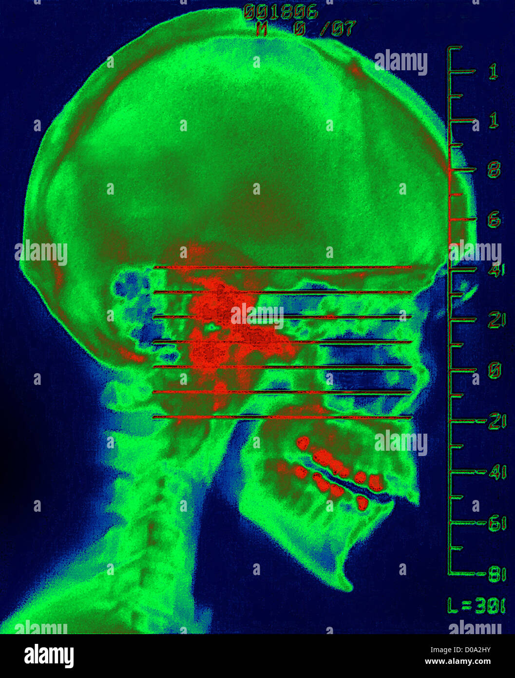 Normal skull x ray hi-res stock photography and images - Alamy