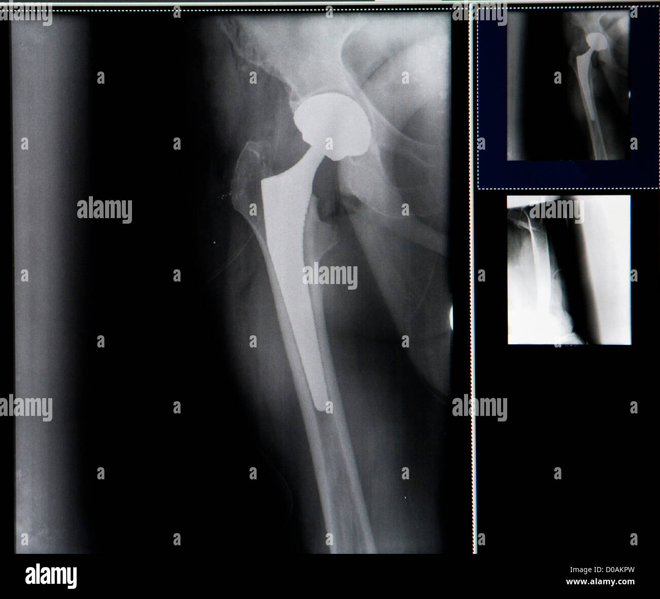 HIP PROSTHESIS, SURGERY Stock Photo - Alamy
