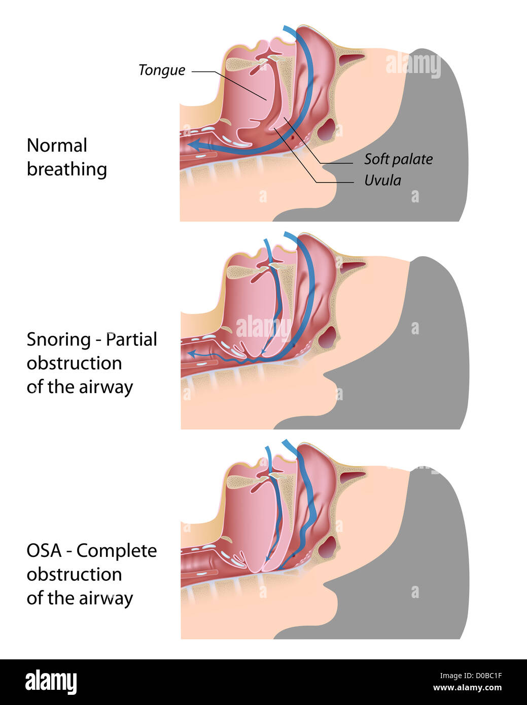 Snoring and sleep apnea Stock Photo - Alamy Snoring and sleep apnea Stock Photo - Alamy